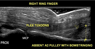 Crimp with Caution: Flexor Tendon Injuries in Rock Climbing